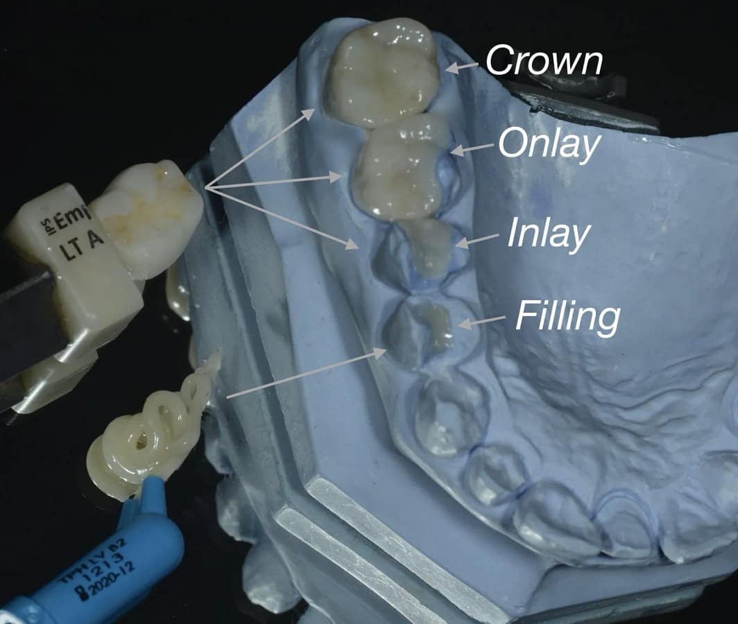 dental clinic in nagercoil|specialised | Inlays,Onlay,& Post